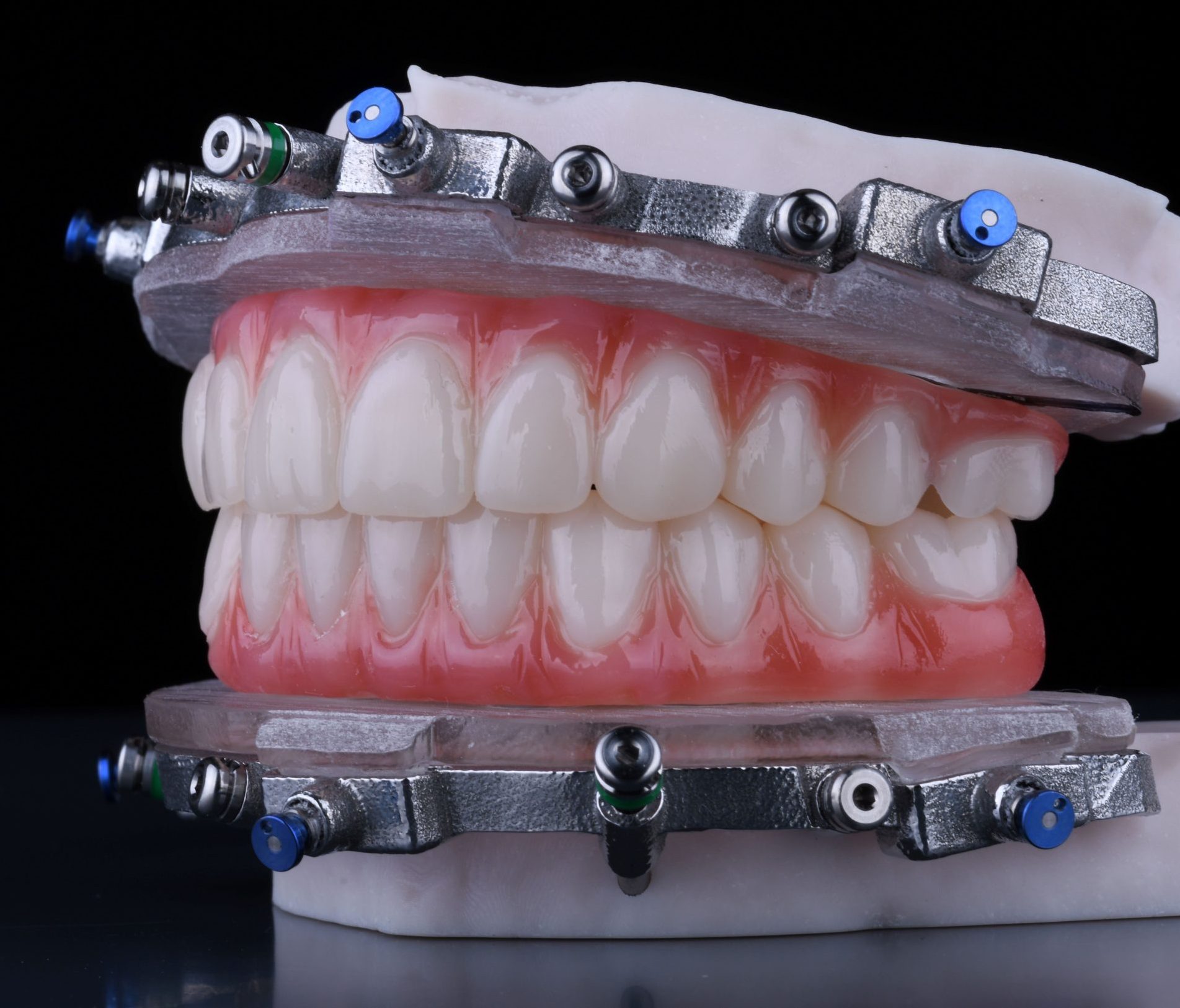 Fully guided, digital full-arch, immediate fixed-hybrid courses